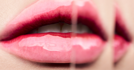 Fillers on the Decline: Is the Over-Filled Lip Trend Finally Ending ...